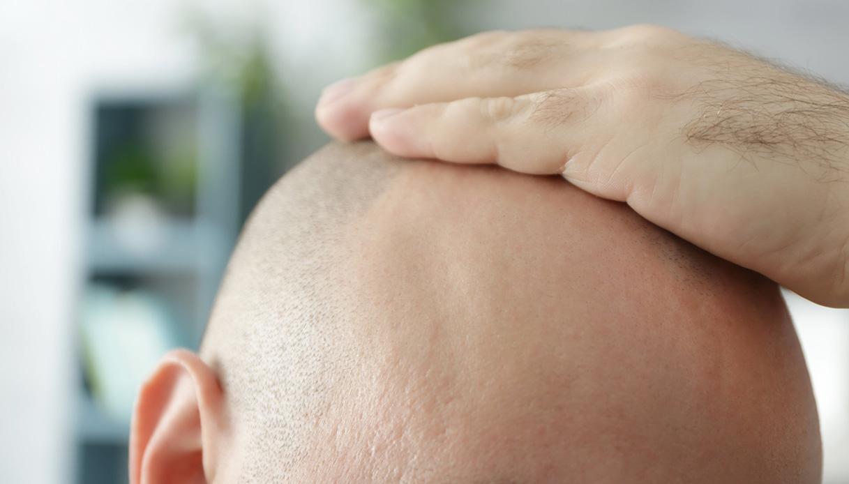 Definire un uomo "pelato" è una molestia sessuale: sentenza storica in ...