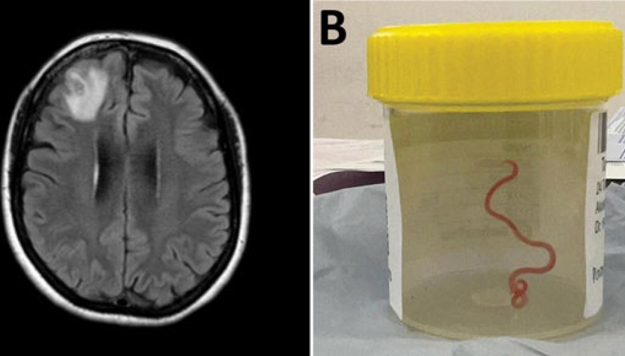 Verme parassita nel cervello e altri organi, raro ma succede anche in ...