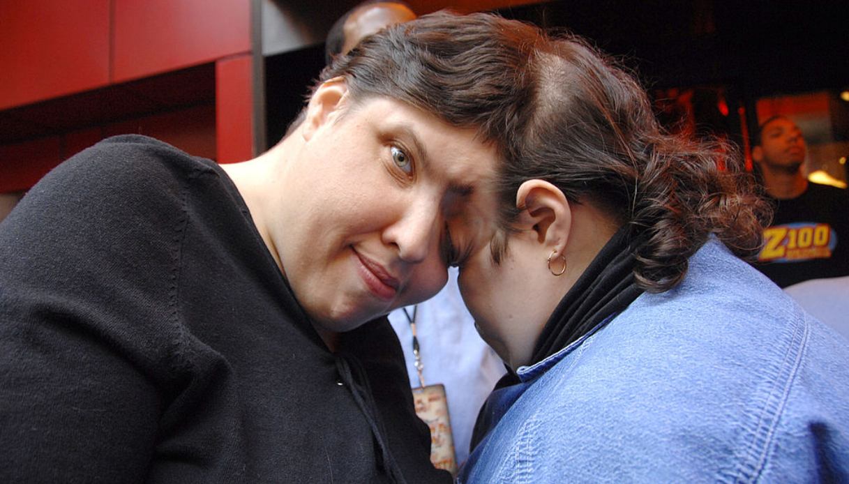 Morti Lori e George Schappell, la coppia di gemelli siamesi craniopagi più vecchia al mondo ...