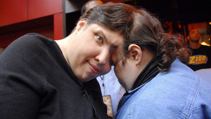 Morti Lori e George Schappell, la coppia di gemelli siamesi craniopagi ...