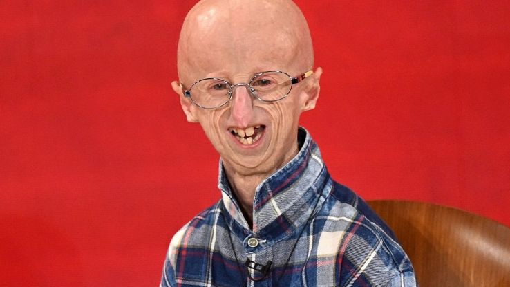 Sammy Basso e la progeria, corpo non sarà donato alla scienza: il chiarimento della madre e l ...